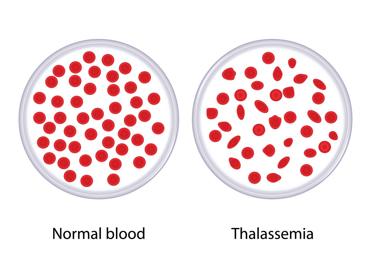 Types of Microcytic Anemia - Facty Health