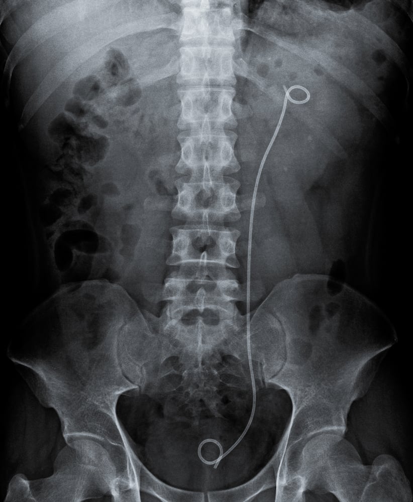 Types of Stents and Their Purposes - Facty Health